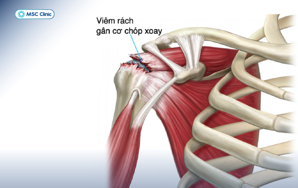 Viêm gân chóp xoay vai tập gì? Hướng dẫn các bài tập hiệu quả từ chuyên ...
